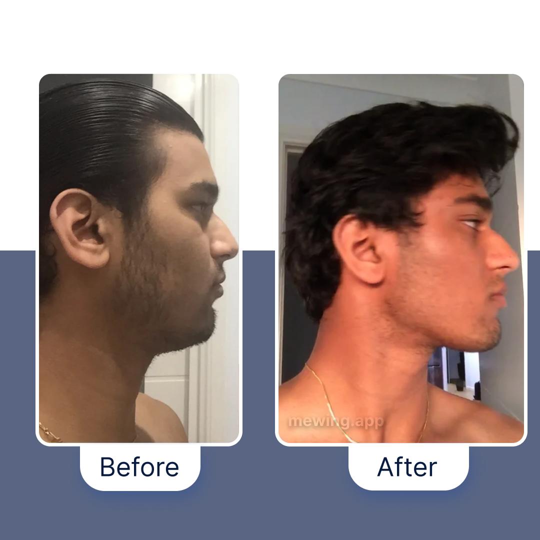 Mewing Before After 122 Progress Photos Male Female Transformations